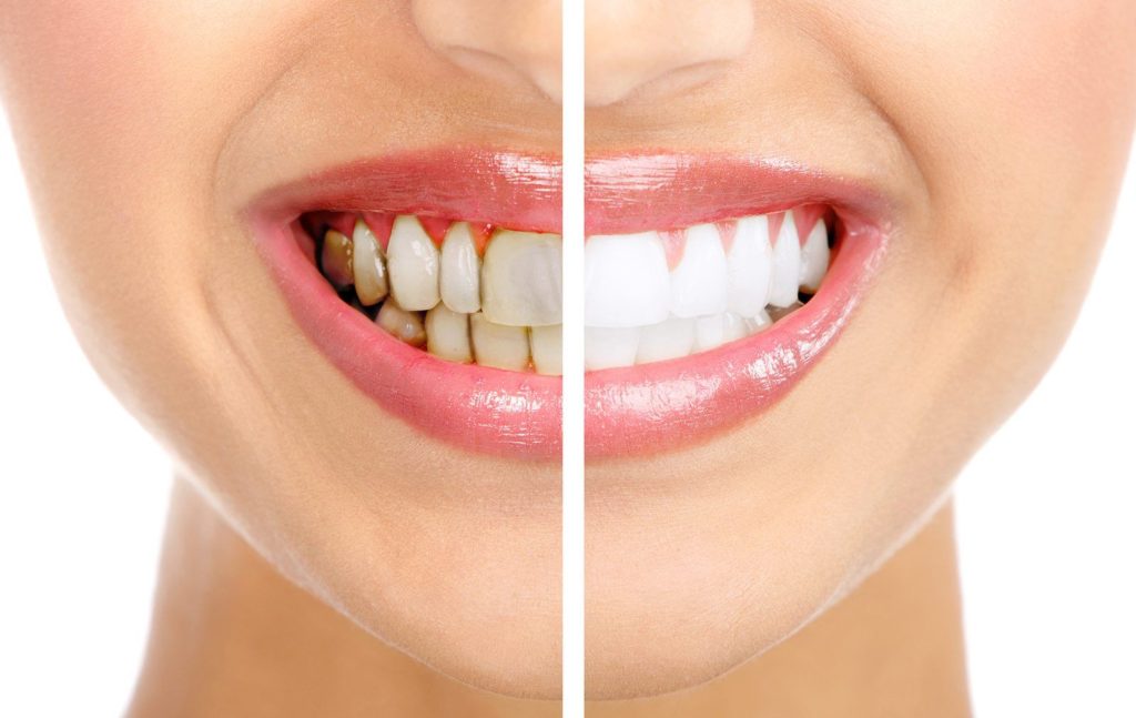 Teeth Scaling - Dental Craft